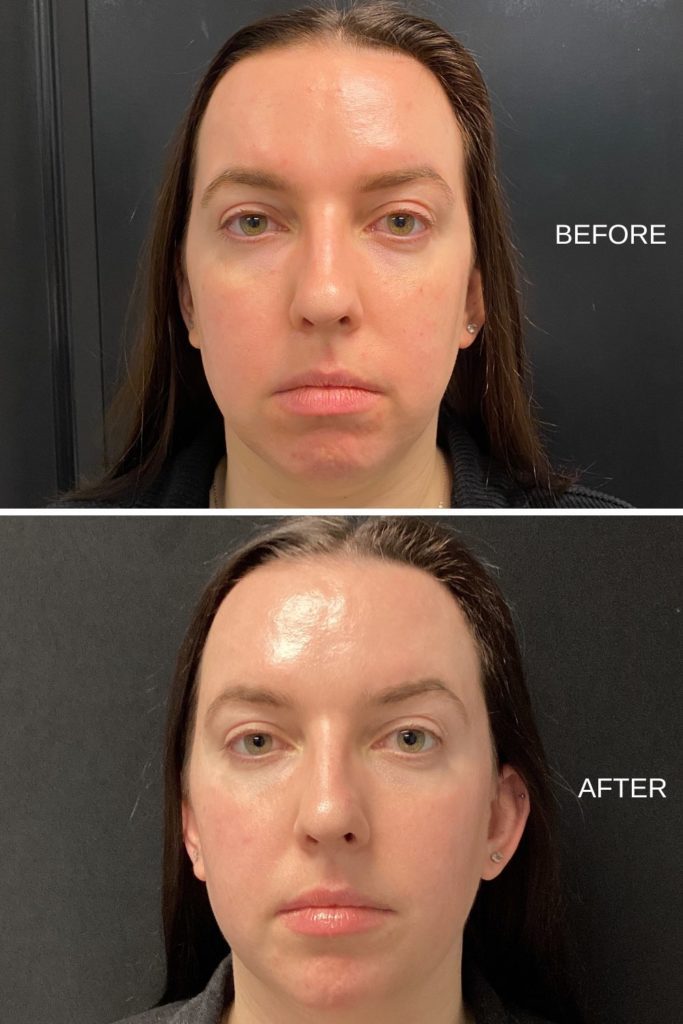 Everything You Need to Know About RHA Filler | Before & After
