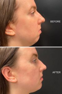 Everything You Need to Know About RHA Filler | Before & After